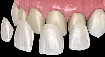 A Step-by-Step Guide to the Veneers Procedure